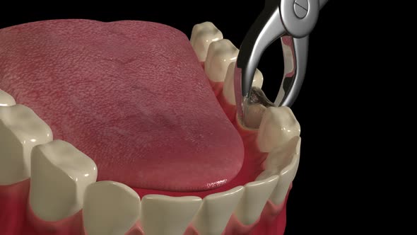 Tooth Extraction, Motion Graphics | VideoHive