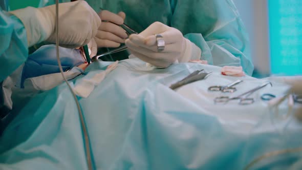 Surgical procedure. Hands in gloves performing an operation on a ...