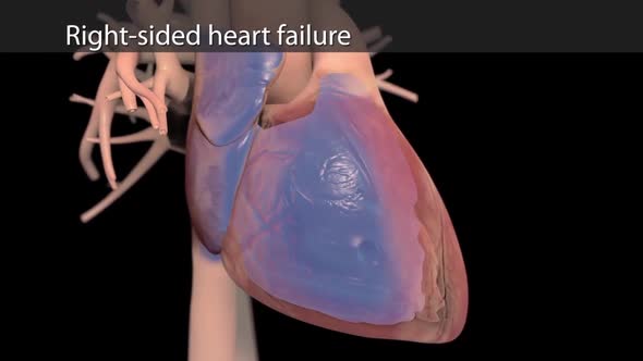 Right sided heart failure, Motion Graphics | VideoHive