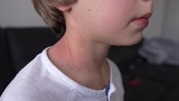 Allergic Skin Reaction on the Childs Neck and Face Red Rash, Stock Footage
