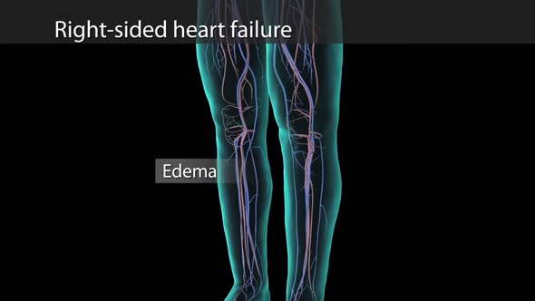 Edema formation in the leg due to right sided heart failure, Motion ...