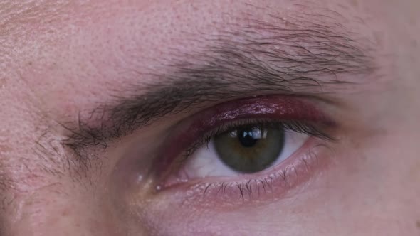 Bruise Over the Eye of a Man Closeup, Stock Footage | VideoHive