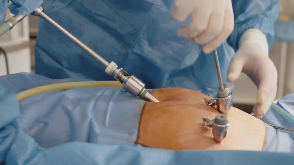 In the Operating Room the Doctor Does a Laparoscopy, Stock Footage