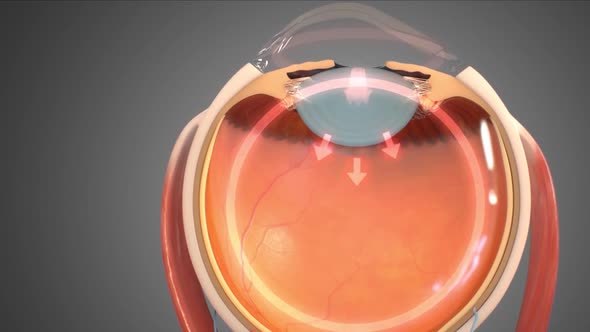 Medical Animation Of Eye Laser Treatment On Blue Background, Motion ...