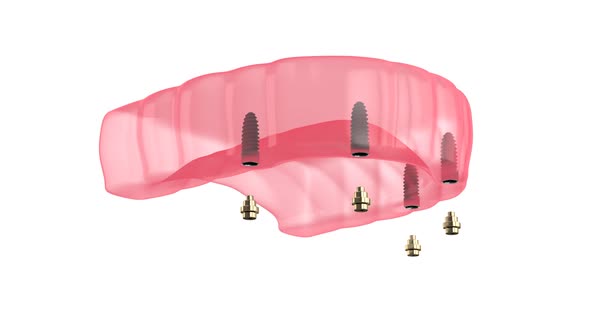 Bar retained removable overdenture installation supported by implants ...