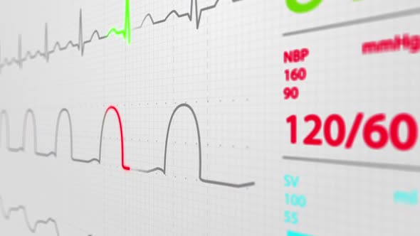 Animation of Intensive Care Unit monitor showing normal values for ...
