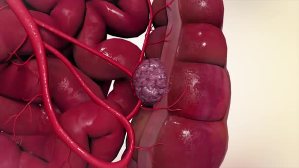 3D Medical animation of colon cancer. Tumor growth, Motion Graphics