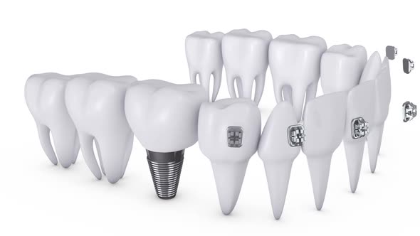 Animation Dental Brackets, Motion Graphics | VideoHive