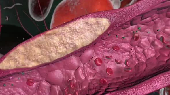 Opening of clotted blood vessels, Motion Graphics | VideoHive