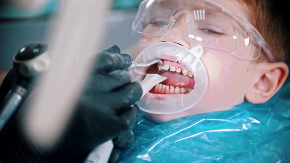 A Little Boy with Damaged Baby Teeth Having a Treatment in the ...