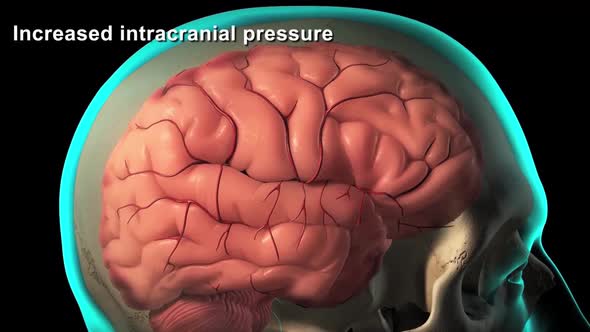 Increased intracranial pressure, brain damage and spinal cord injury ...