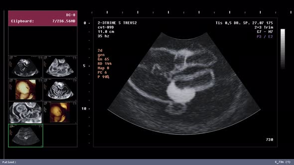 X-ray analysis system at hospital determines female sex of an unborn ...