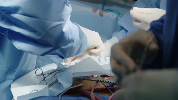 Surgeons working during open heart surgery, close up on hands and ...