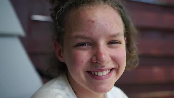 Close Up Portrait of a Smiling Bright Teenage Girl with Teenage Rashes ...
